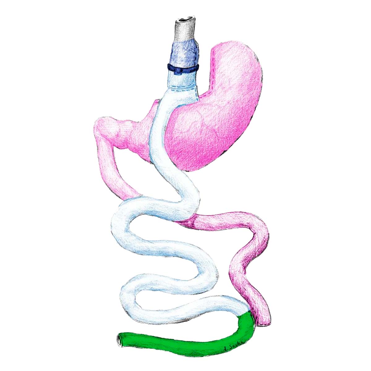 BRYGB - Diabetes Surgery